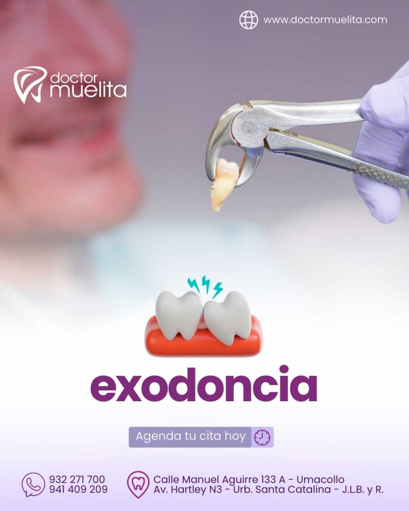 Exodoncia - Doctor Muelita