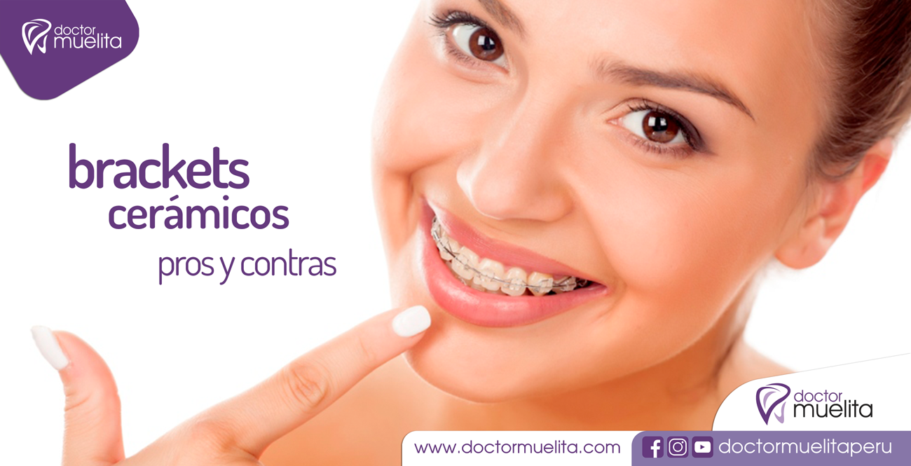 Brackets Esteticos Ceramicos at Laura Kiek blog