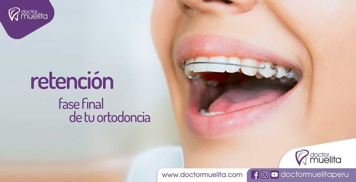 retenedor-dental - Doctor Muelita