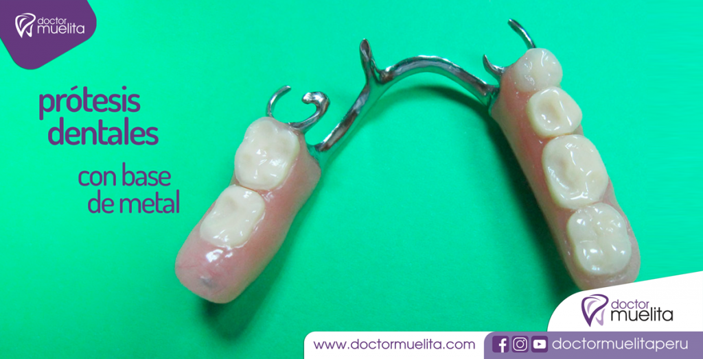 Prótesis Dentales con base de metal - Doctor Muelita