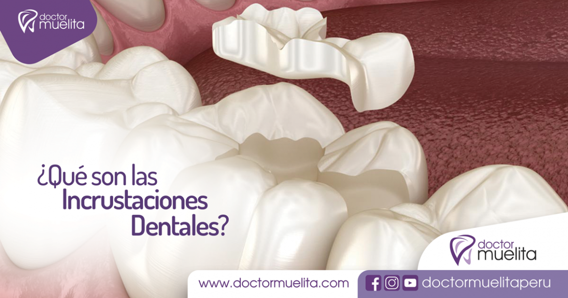 ¿Qué son las Incrustaciones Dentales? - Doctor Muelita